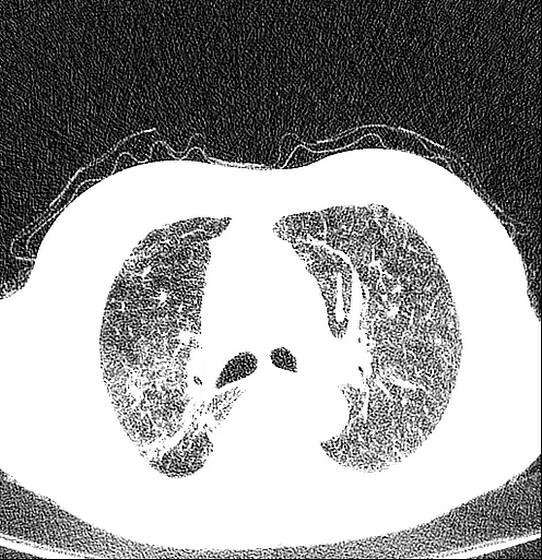 Ki sa yo itilize yon machin CT Scan? | Yon Gid konplè - MeCanMedical